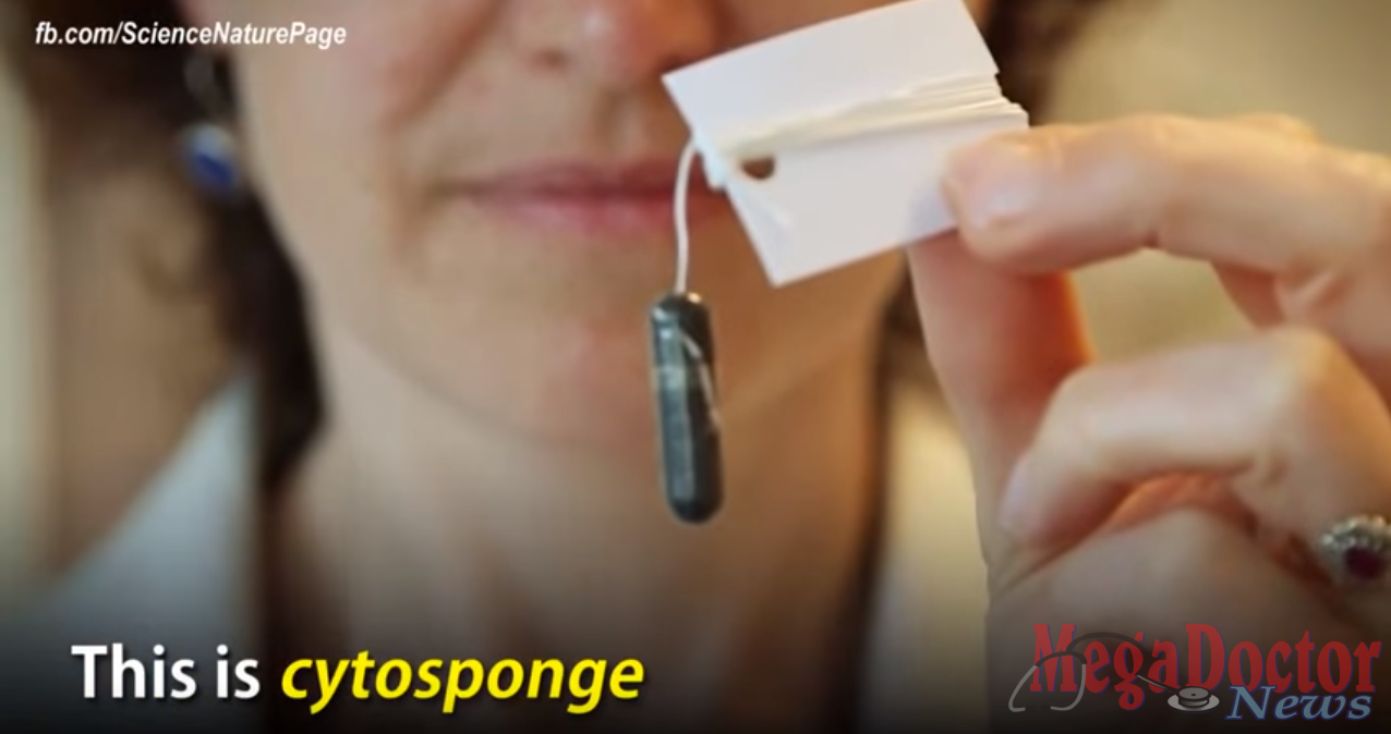 Cytosponge - Early detection for oesophageal cancer - Mega Doctor News