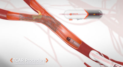 DHR Health Performs First TCAR Procedure in Hidalgo County - Mega ...