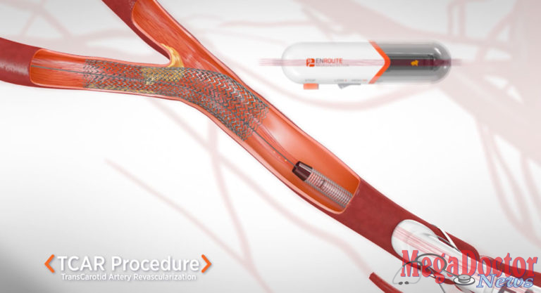 DHR Health Performs First TCAR Procedure in Hidalgo County - Mega ...