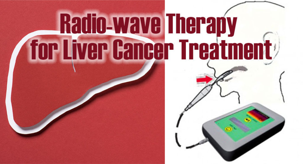 Radio-wave Therapy Is Safe for Liver Cancer Patients and Shows ...