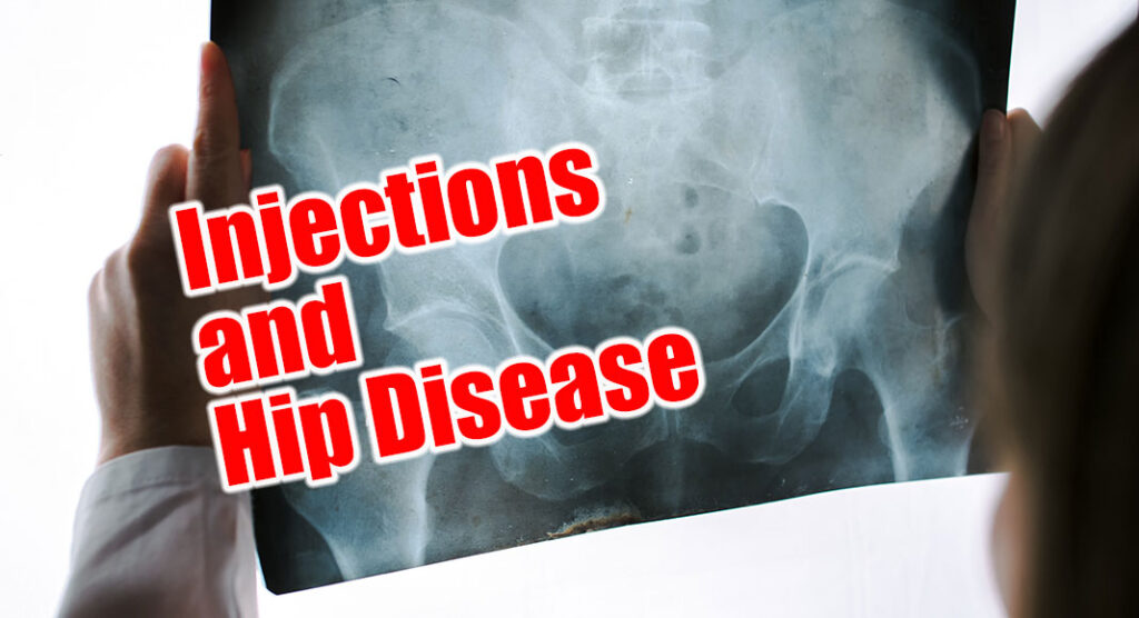 Corticosteroid Injections of Hip Linked to 'Rapidly Destructive Hip ...