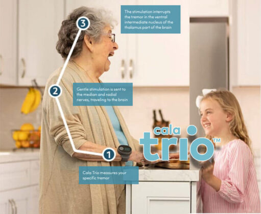 Cala Trio™; The first non-invasive personalized therapy for hand ...