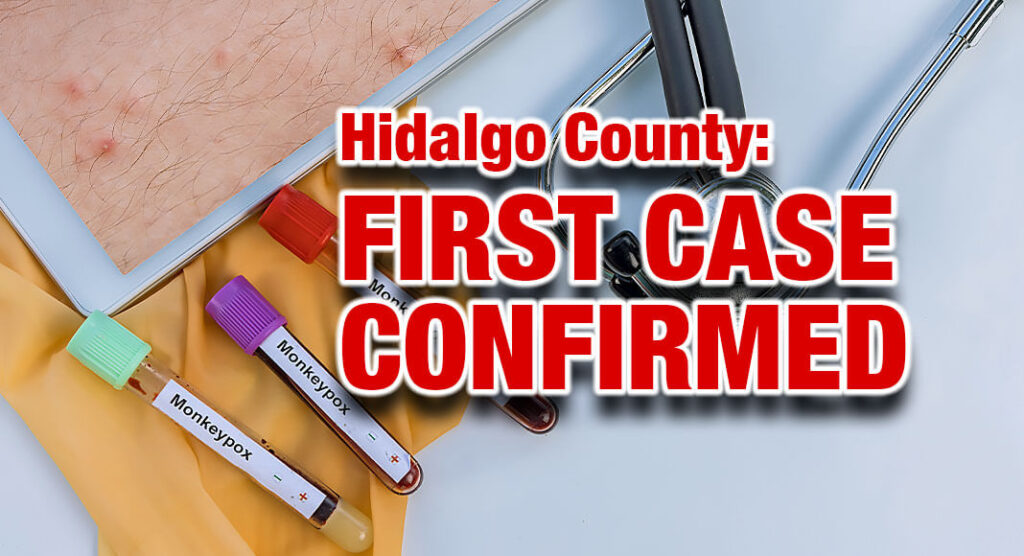 First case of monkeypox in Hidalgo County is confirmed - Mega Doctor News
