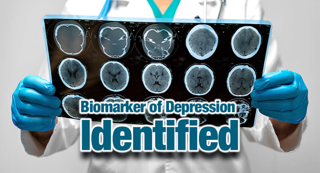 Brain Imaging-Based Biomarker of Depression Identified - Mega Doctor News