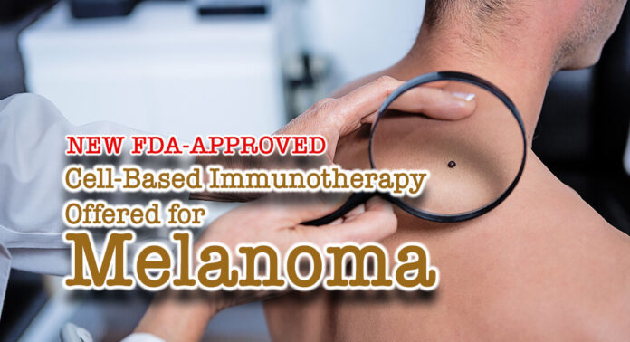 New Cell-Based Immunotherapy Offered for Melanoma - Mega Doctor News