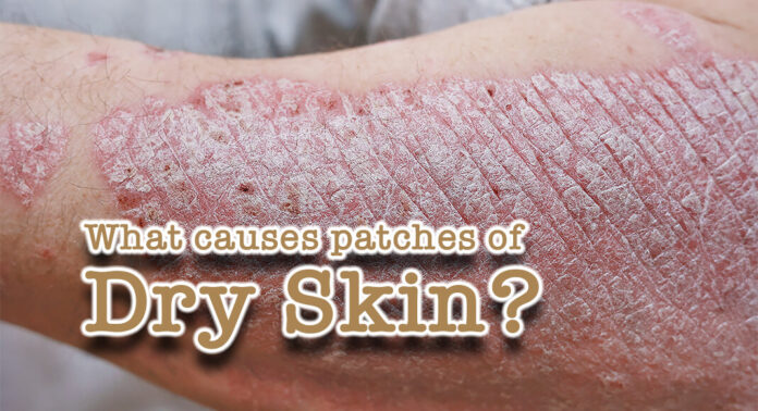 What causes patches of dry skin? - Mega Doctor News