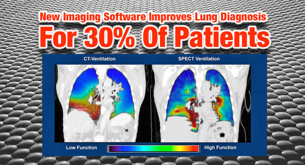 New Imaging Software Improves Lung Diagnosis For 30% Of Patients Who ...