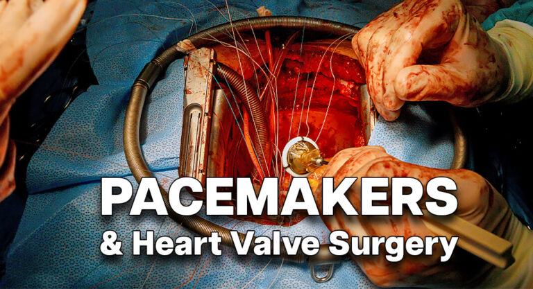 How Common Is Pacemaker Use After Heart Valve Surgery? - Mega Doctor News
