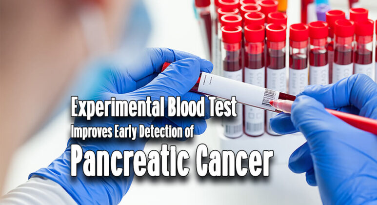 Experimental Blood Test Improves Early Detection of Pancreatic Cancer ...
