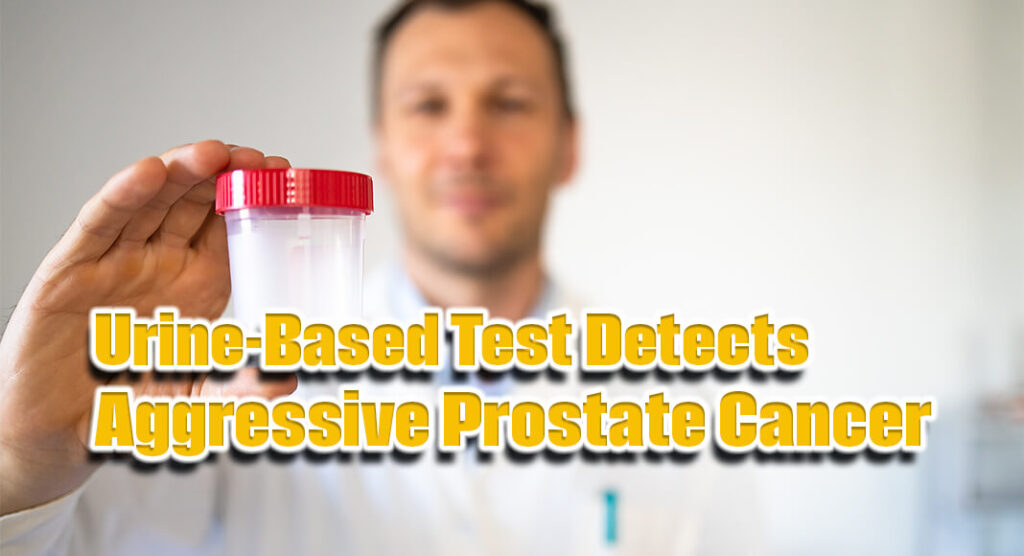 Urine-Based Test Detects Aggressive Prostate Cancer - Mega Doctor News