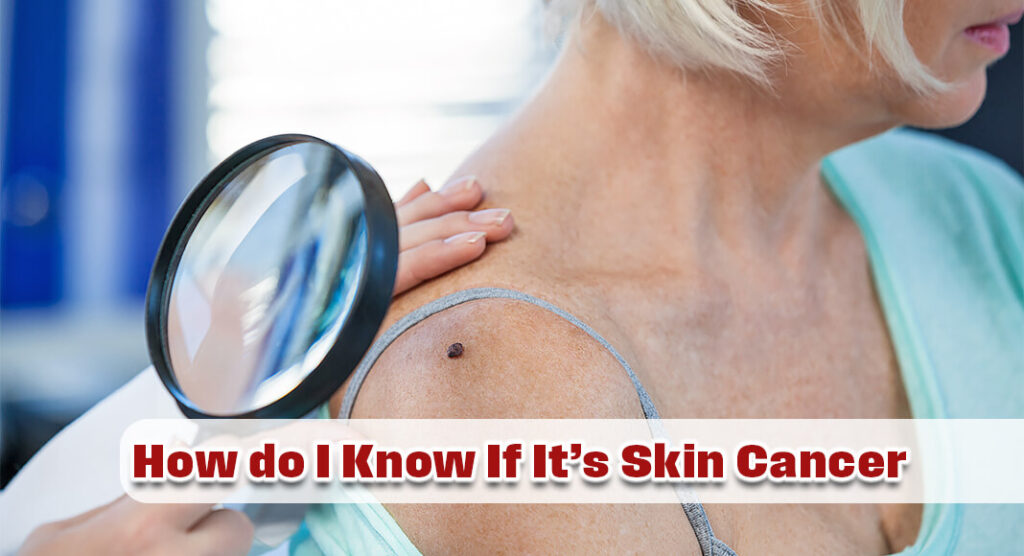 Moles, Spots, and Changes: How to Tell If It’s Skin Cancer - Mega ...