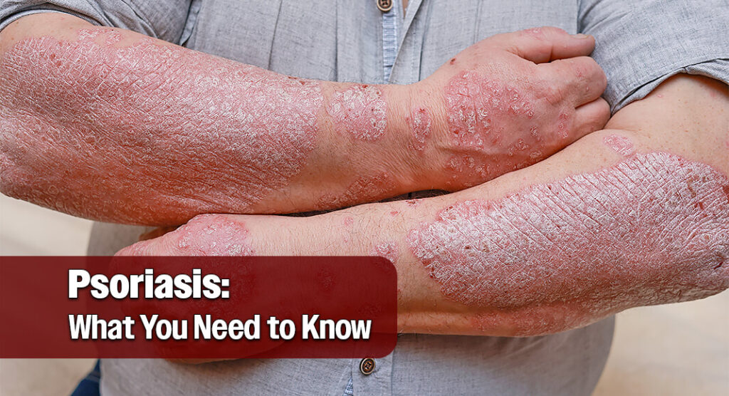 What are the signs, symptoms, and types of psoriasis? - Mega Doctor News