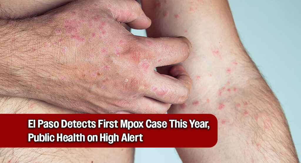 El Paso Public Health Officials Confirm First Case of Mpox in 2025 ...